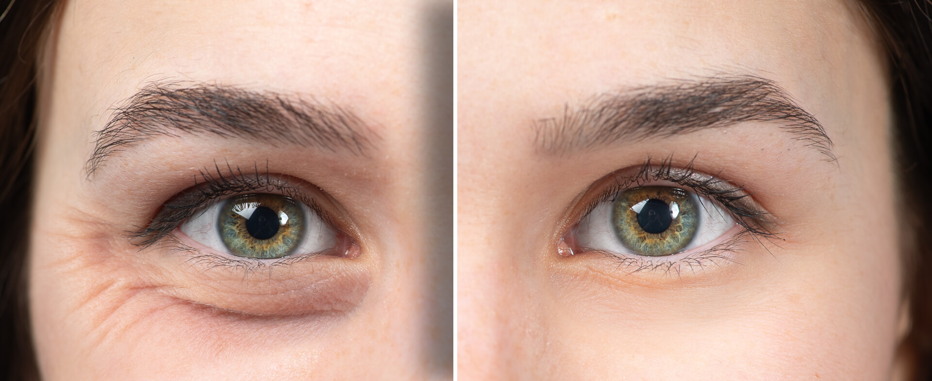 Botulinum Toxin (Botox) Application - Jiva Clinic